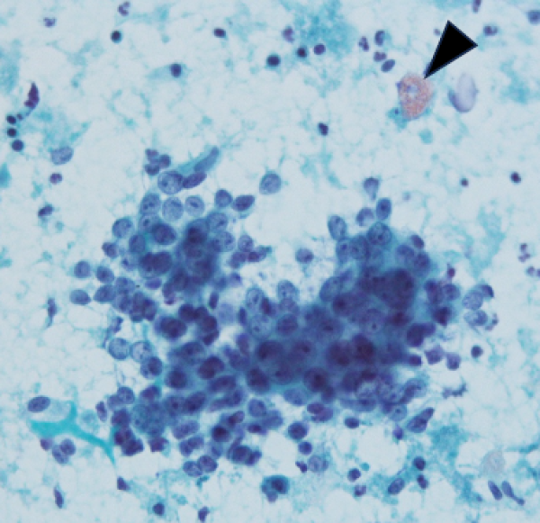 BAC Case Study and Quiz for September - A subcutaneous neck lump in a ...